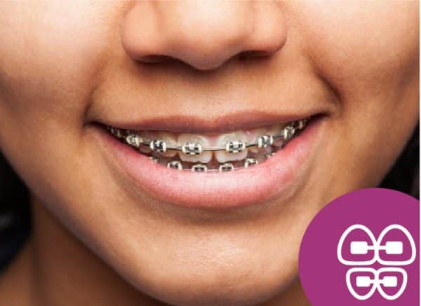 Brackets En San Luis Potosí - Expertos En Ortodoncia Agenda Aquí